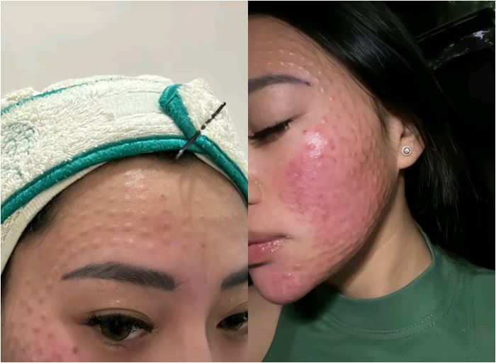 Manfaat Salmon DNA, Perawatan Wajah Wendy Walters yang Viral di TikTok ...