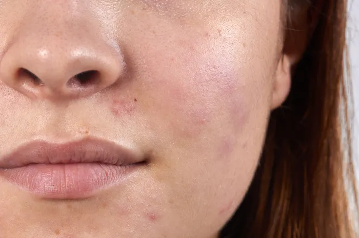 8 Bahan Aktif Skincare untuk Mengatasi Bekas Jerawat PIE, Salah Satunya ...