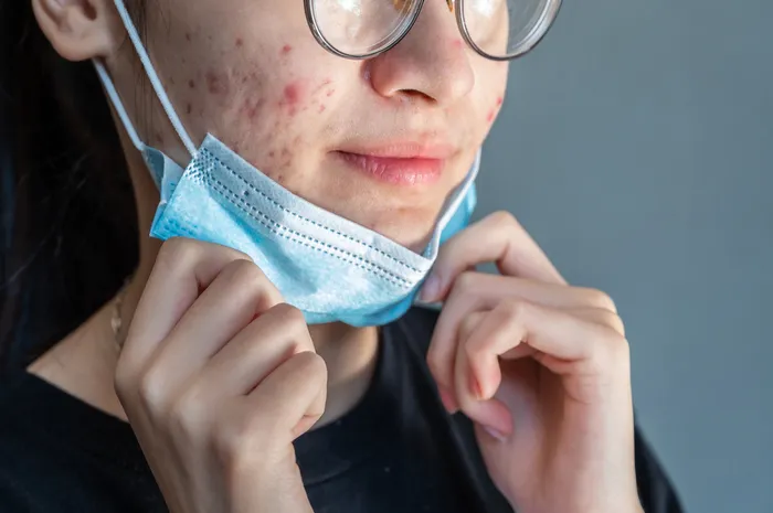 Sambut Acne Awareness Month, Yuk Cari Tahu Apa Itu Acne Mechanica ...