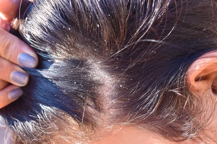 Viral di TikTok, Ini Manfaat Tea Tree Oil untuk Mengatasi Ketombe - Semua Halaman - Parapuan