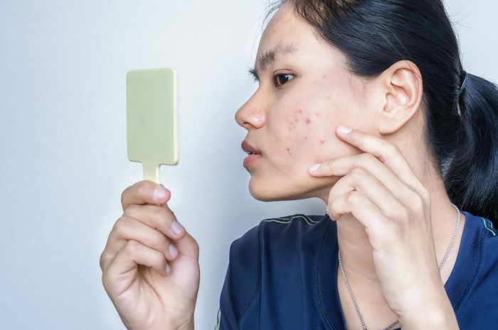 Sering Salah Arti, Ini Perbedaan Purging dan Breakout Akibat Skincare ...