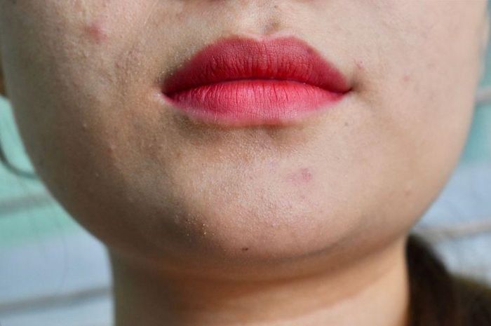 Apa Itu Beruntusan? Masalah Kulit yang Kerap Terjadi pada Perempuan ...