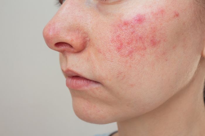 Viral di TikTok, Ini Perbedaan Jerawat dan Rosacea yang Tampak Mirip ... Viral di TikTok, Ini Perbedaan Jerawat dan Rosacea yang Tampak Mirip ...