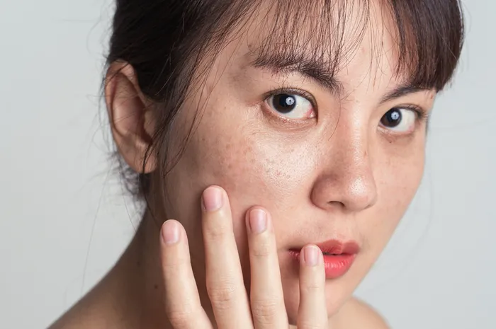 Kenali 2 Penyebab Munculnya Freckles di Wajah dan Cara Mencegahnya ...