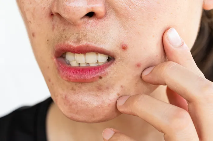 4 Cara Mengatasi Acne Mechanica, Jerawat yang Timbul Akibat Gesekan ...