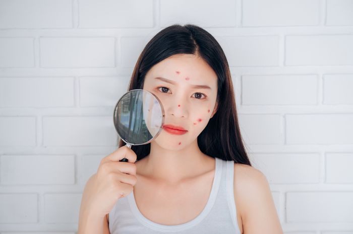 4 Tips Pakai Acne Patch untuk Kempiskan Jerawat, Jangan Langsung Tempel ...