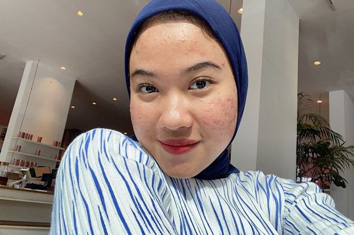 Jadi Pejuang Jerawat, Ini Kisah Ratu Ghania Temukan Makna Self Love ...
