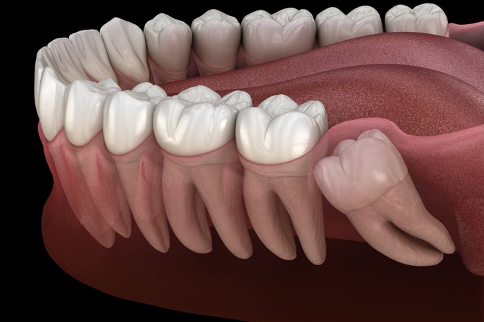 Mengenal Impaksi, Kapan Waktu yang Tepat untuk Cabut Gigi Bungsu ...