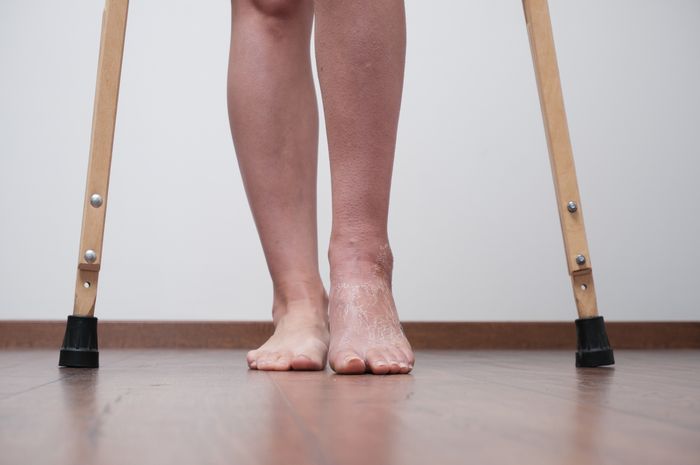 Kondisi Penipisan Jaringan Otot, Apa Itu Kondisi Muscle Atrophy? - Parapuan