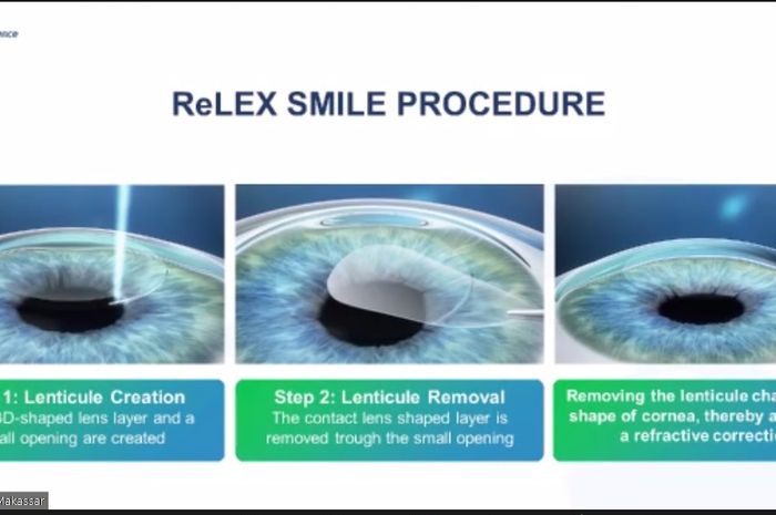 ReLEX SMILE, Metode Baru Mengatasi Mata Minus dan Silinder Selain Lasik - Parapuan